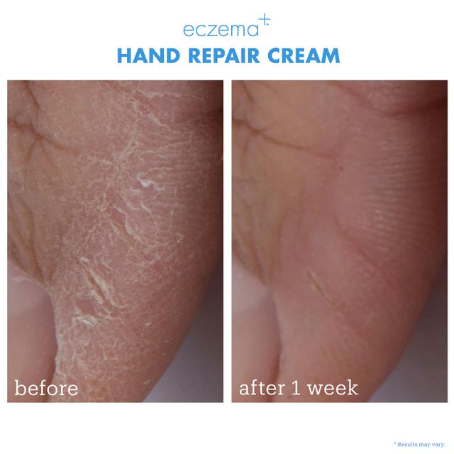 Skinfix Eczema+ Hand Repair Cream | Mall of America®