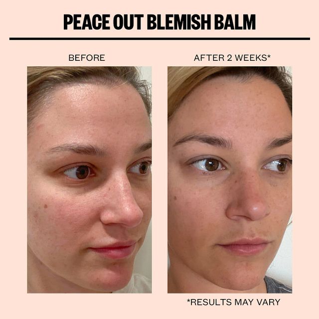 Peace Out Blemish Balm Cleanser | Mall of America®