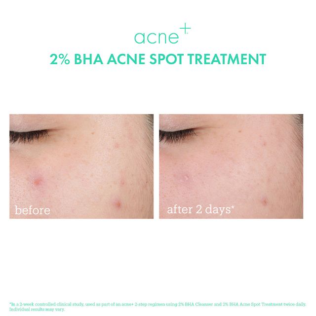 Skinfix Acne+ 2% BHA and Azelaic Acid Acne Spot Treatment | Mall of ...
